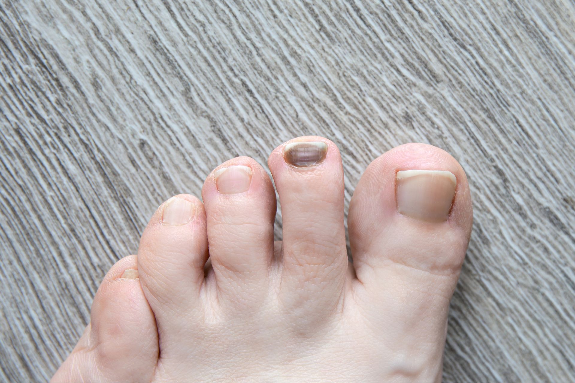 Toenail Trauma and Discolouration
